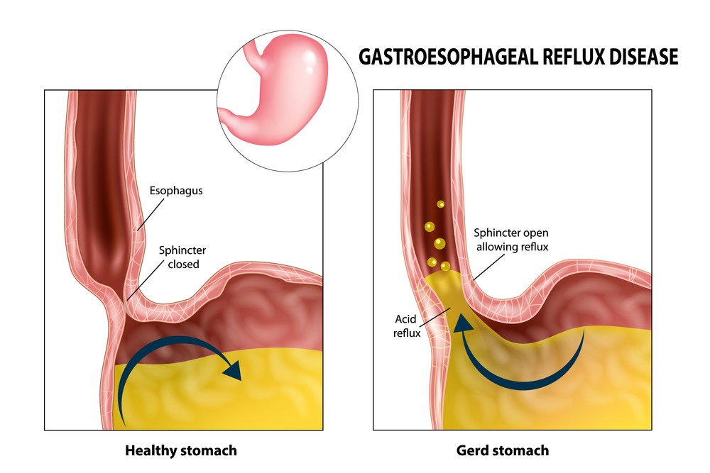 Diagnosis And Management Of Typical And Atypical GastroEsophageal Diagnosis And Management Of Typical And Atypical GastroEsophageal